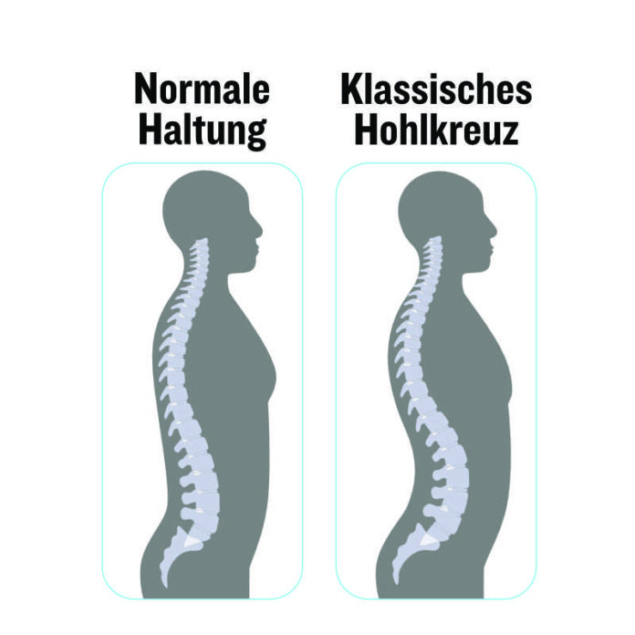 Hohlkreuz loswerden: Diese Übungen helfen | Beat Yesterday