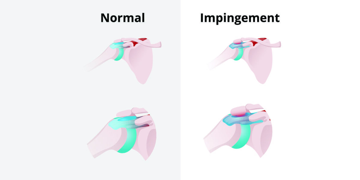 Impingement-Syndrom: Was sofort gegen Schulterschmerzen hilft | # ...